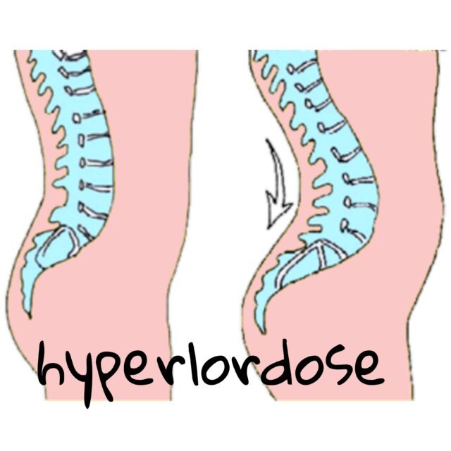 Hyperlordose : Exercices de correction - santemedicals.com