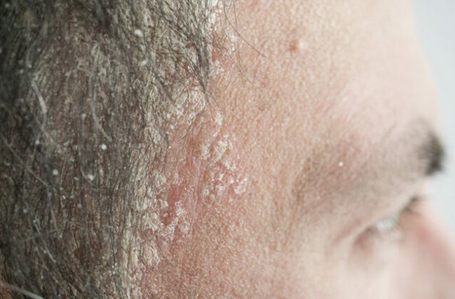 Le psoriasis du cuir chevelu cause-t-il la perte de cheveux ...