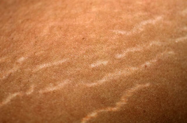 Ce que vous devez savoir sur les vergetures sur vos seins ...