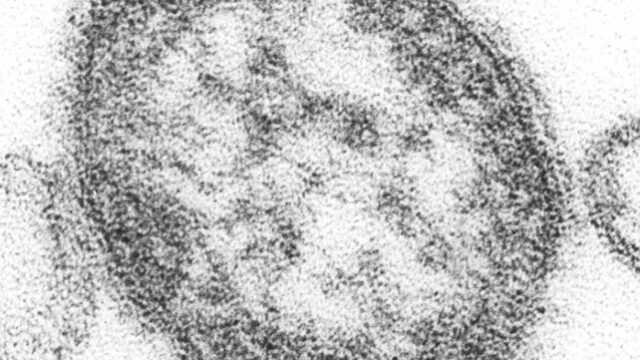 À quoi ressemble la rubéole (rougeole) ? - santemedicals.com