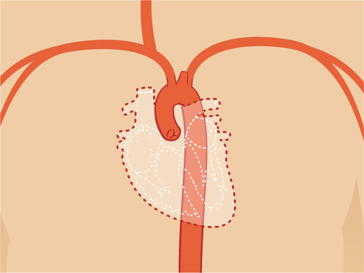 Anatomie, Diagramme Et Fonction De L'artère Axillaire - Santemedicals.com