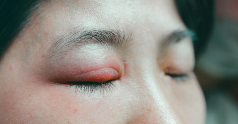 Morsure d'araignée sur une paupière : symptômes, traitement, obtenir de ...