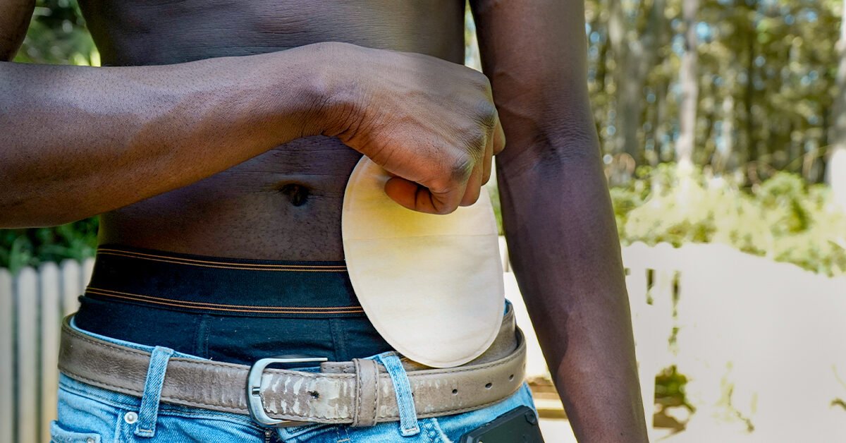 Prolapsus De Colostomie : Ce Que Vous Devez Savoir - Santemedicals.com