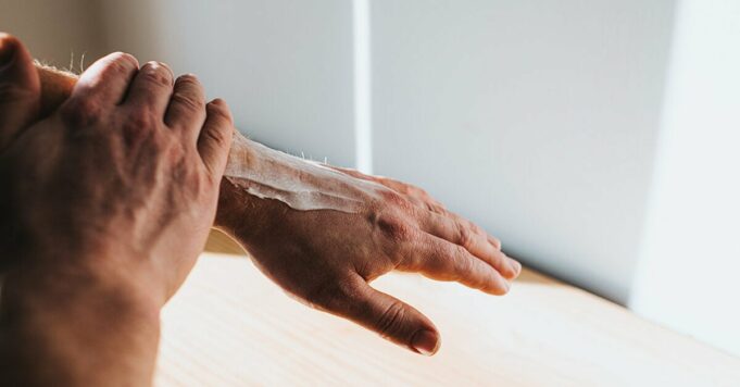 Psoriasis des mains : images, prise en charge et prévention ...