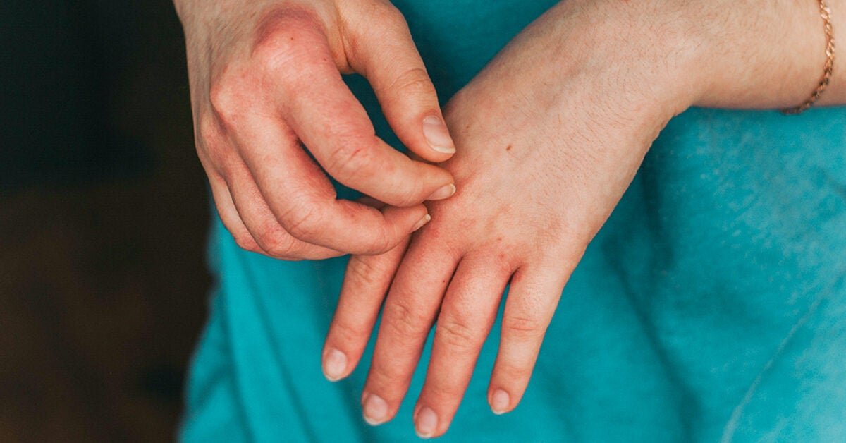 7 Types D'eczéma : Symptômes, Causes Et Images - Santemedicals.com
