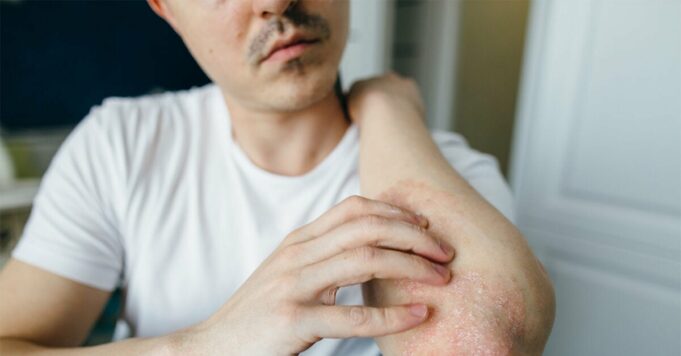 Images, signes et symptômes généralisés du psoriasis pustuleux ...