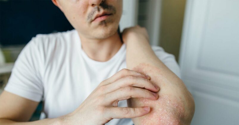 Images, signes et symptômes généralisés du psoriasis pustuleux ...
